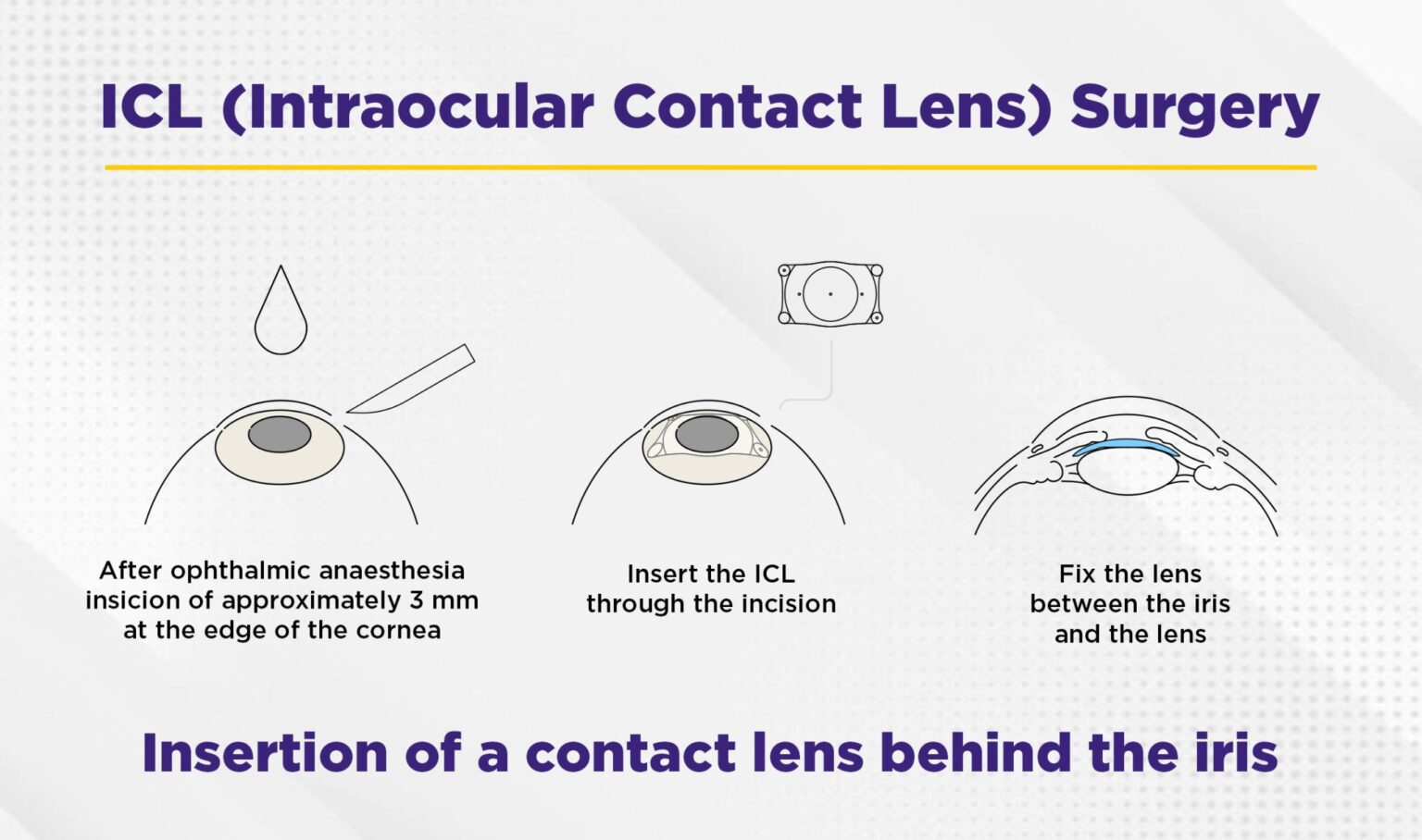 Thinking About ICL Eye Surgery? Here's What to Know - Dr. Chameen Sams