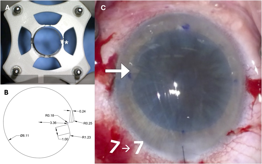 Breakthrough in Corneal Surgery Makes the Procedure Quicker & Safer ...